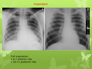 Chest x ray basics | PPTX