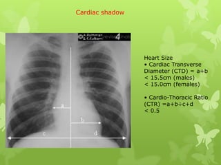 Chest x ray basics | PPTX