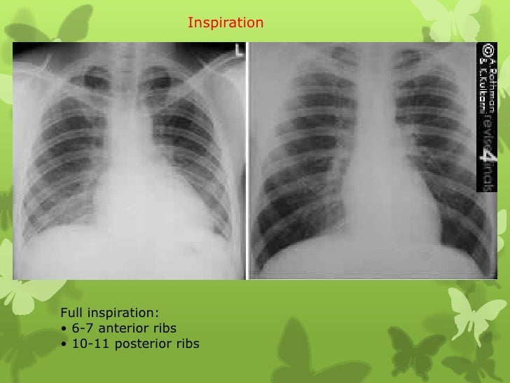 Chest x ray basics