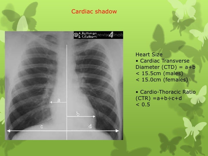 Chest x ray basics Chest x ray basics