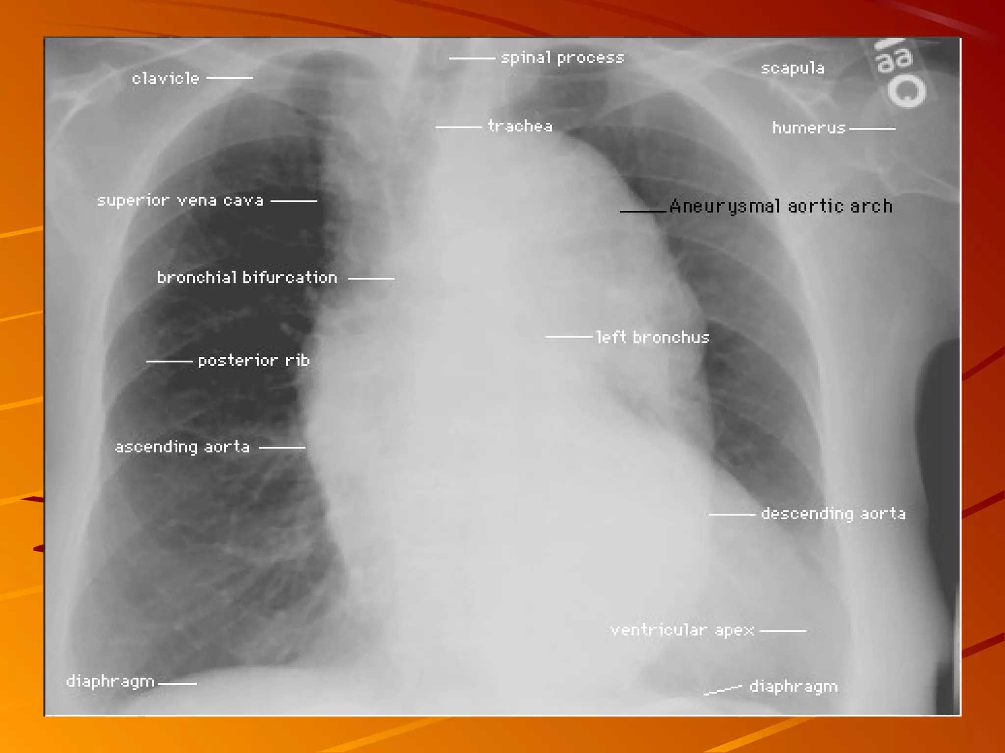Chest x ray dasic approach 2015 - dr magdi sasi | PPT