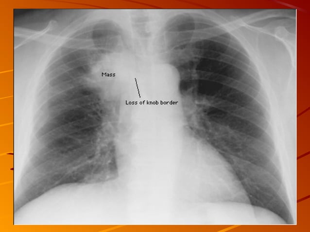 Chest x ray dasic approach 2015 - dr magdi sasi | PPT