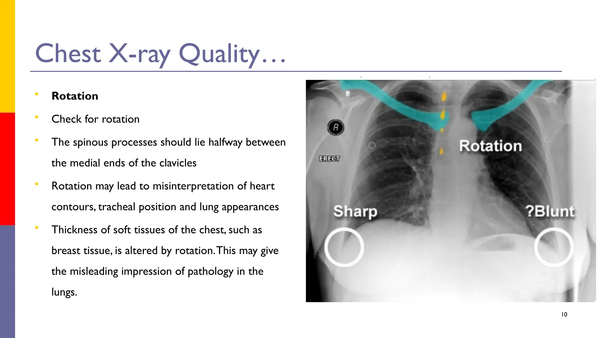 Chest Xray interpretation and normal Abdikadir Hassan .pptx
