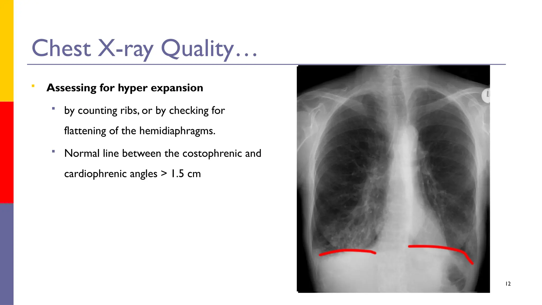 Chest Xray interpretation and normal Abdikadir Hassan .pptx