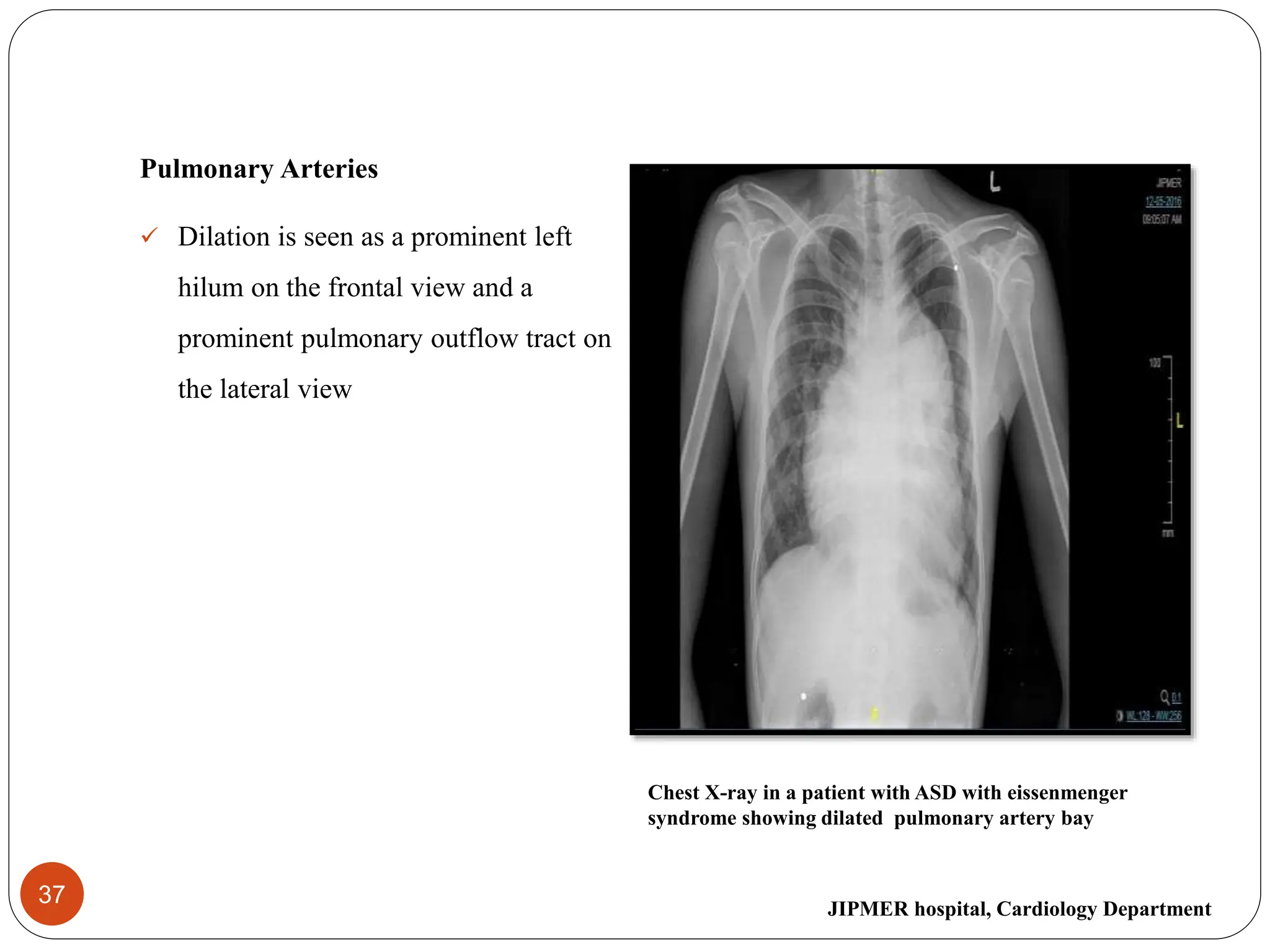 chestxrayforevaluationofcardiovascularsystem-170204135120.pdf