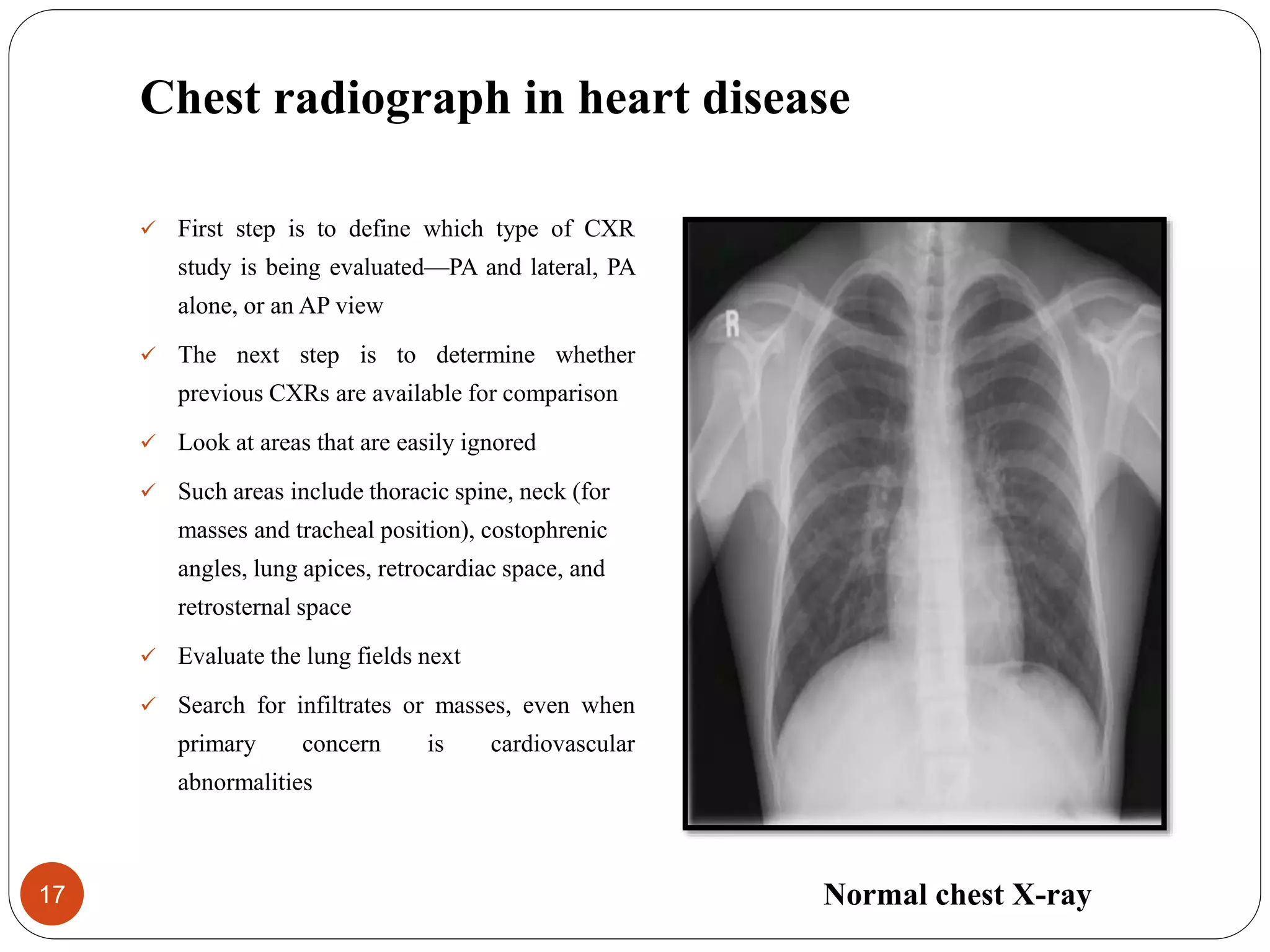 Chest xray for evaluation of cardiovascular system | PPTX