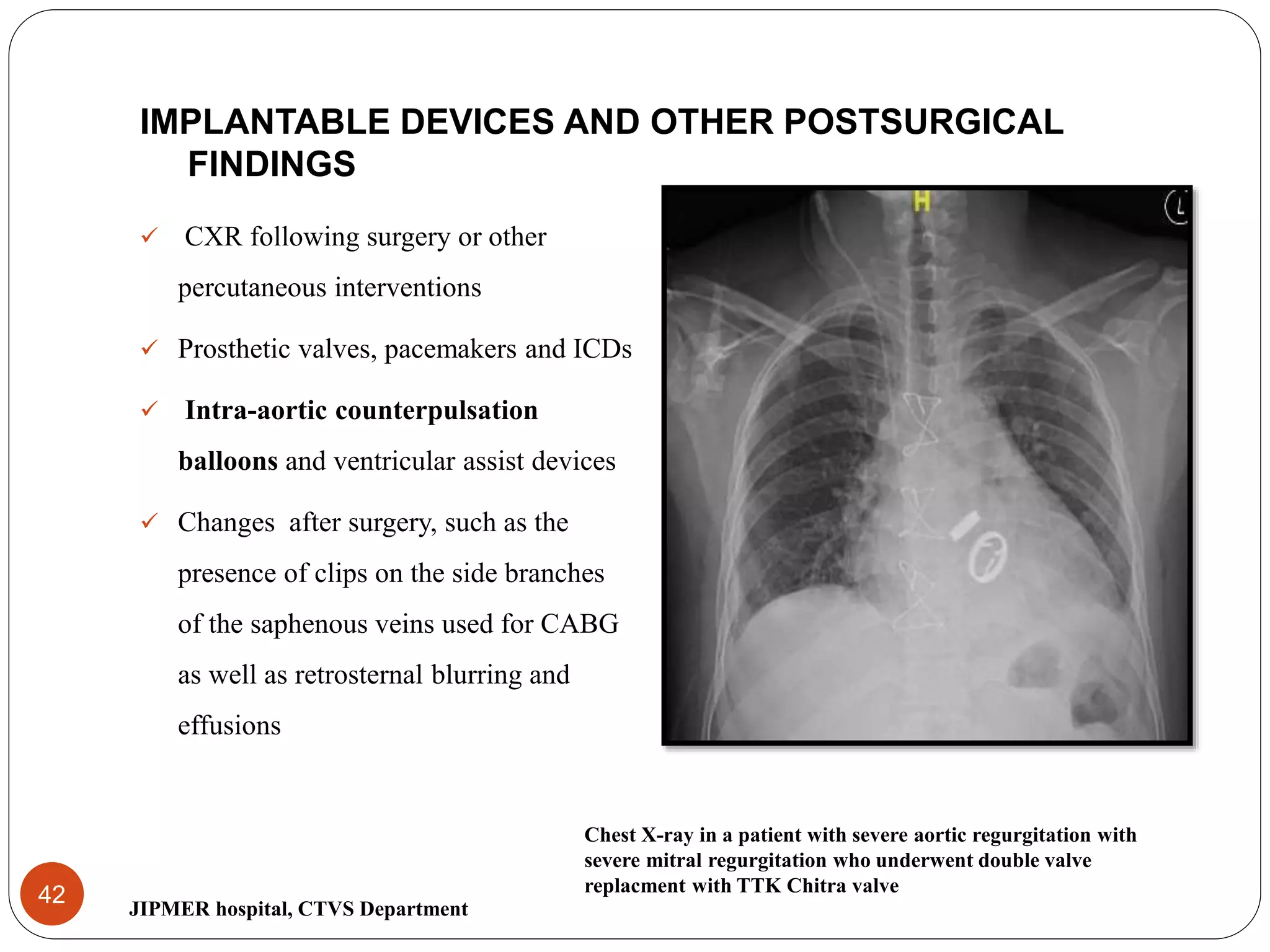 Chest xray for evaluation of cardiovascular system | PPTX