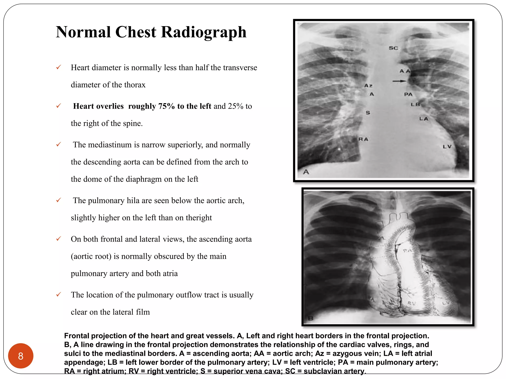 Chest xray for evaluation of cardiovascular system | PPTX