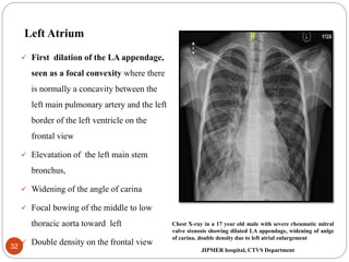 Cephalization Of Pulmonary Vessels