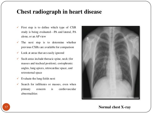 Pediatric Chest Xray Interpretation Youtube
