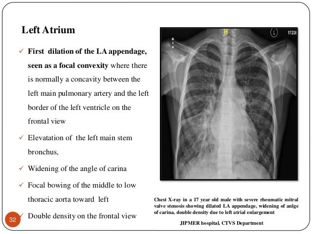 Chest xray for evaluation of cardiovascular system