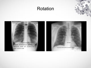 Chest x ray for surgeons | PPT