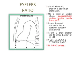 Chest x ray in relation to cardiovascular evaluataion.pptx