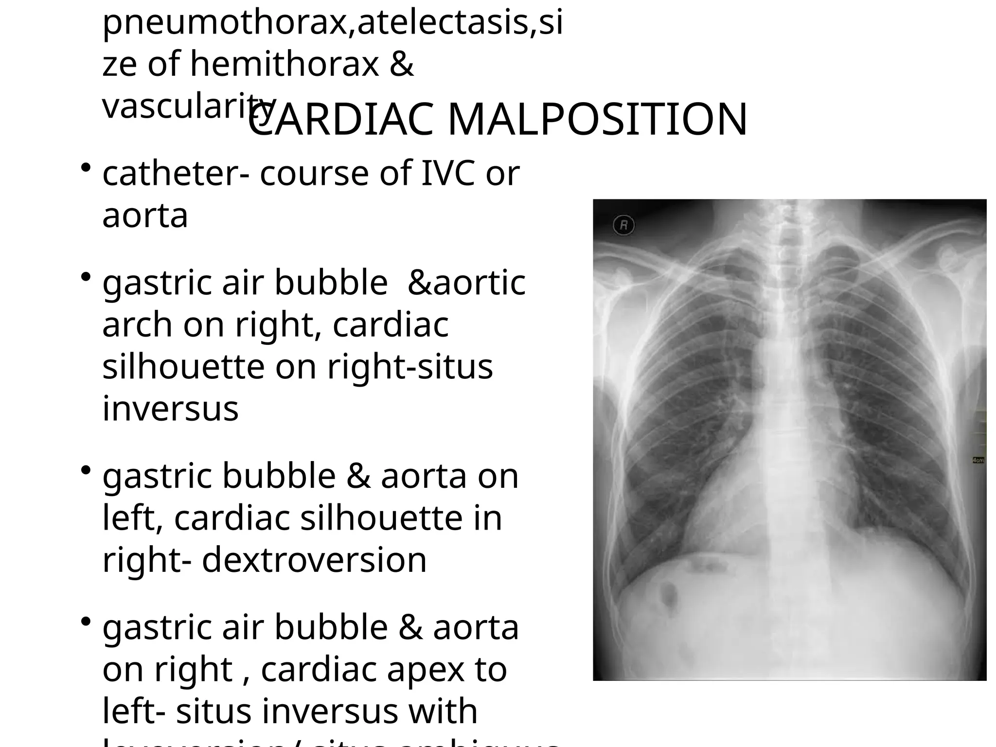 CHEST X RAY IN CONGENITAL HEART DISEASE2.pptx