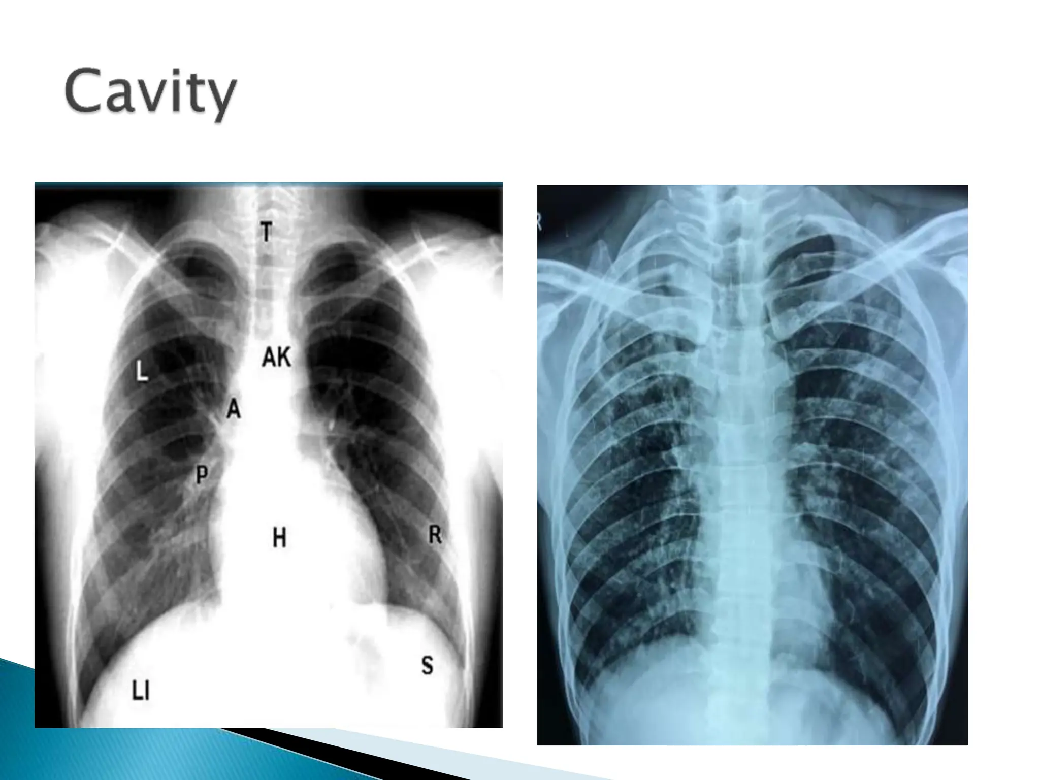 Chest X Ray Interpretation-1.pptx by srinivas | PPT