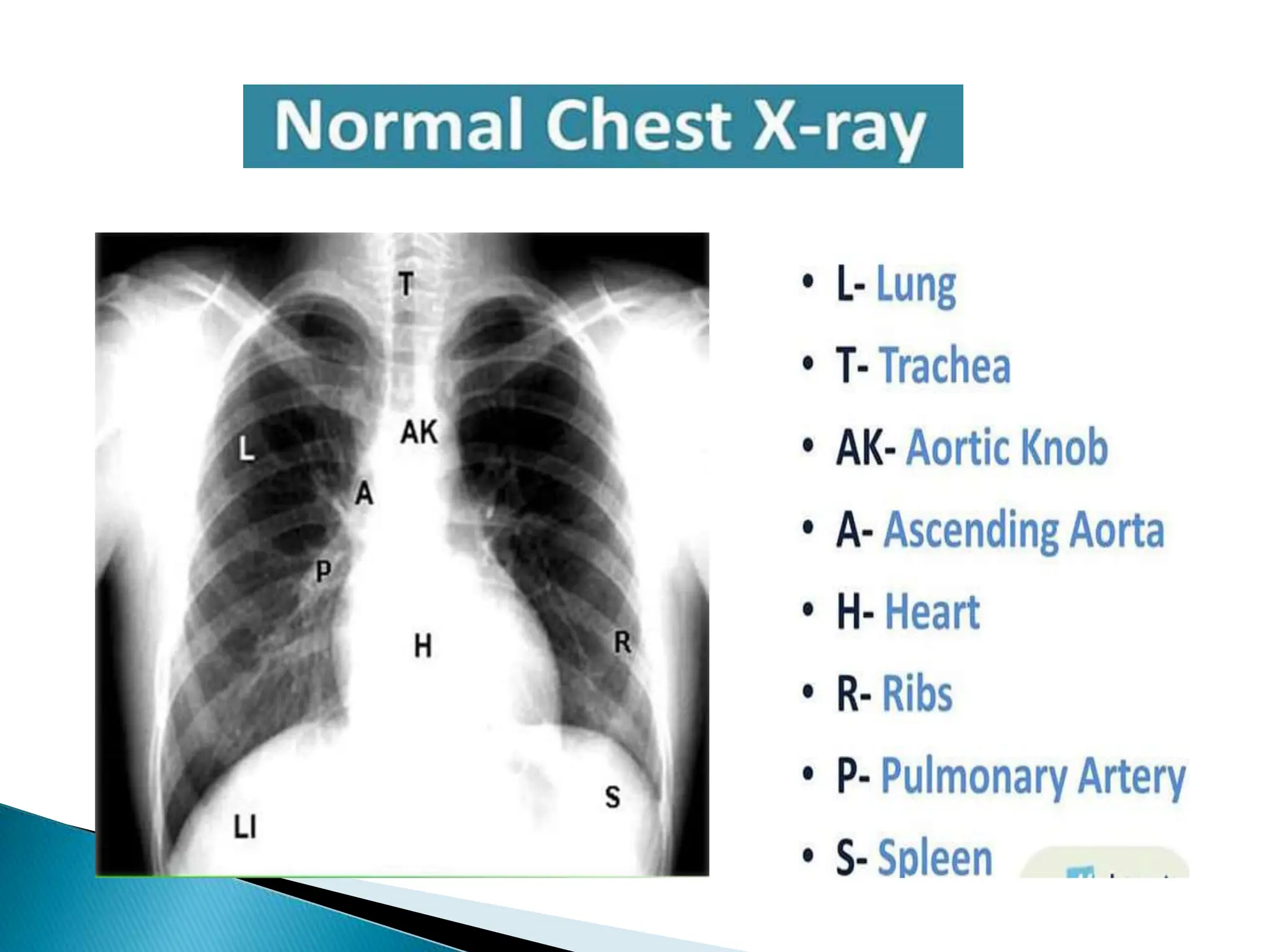 Chest X Ray Interpretation-1.pptx by srinivas | PPT | Free Download