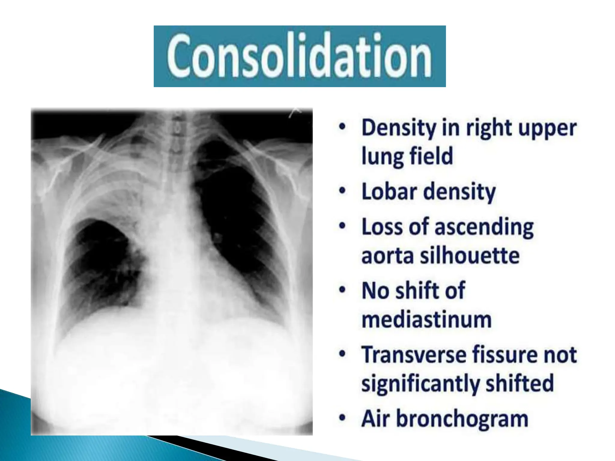 Chest X Ray Interpretation-1.pptx by srinivas | PPT | Free Download