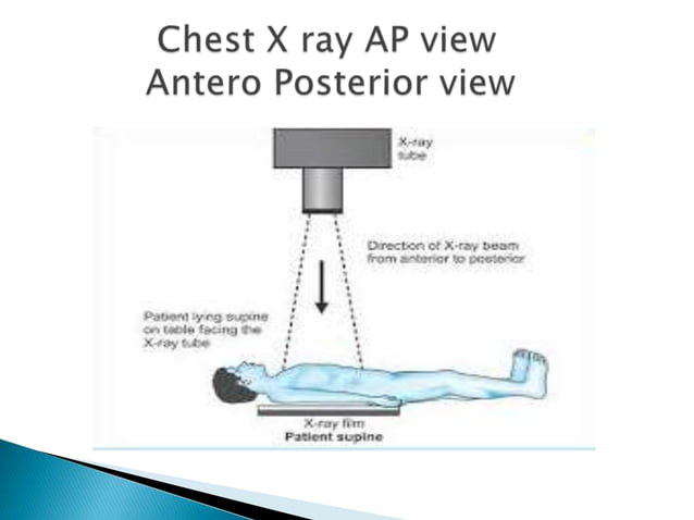 Chest X Ray Interpretation-1.pptx by srinivas | PPT