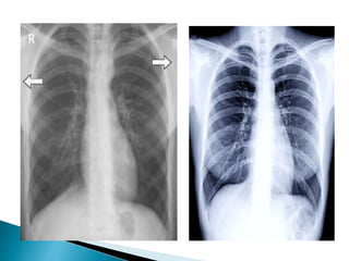 Chest X Ray Interpretation 1 Pptx By Srinivas Pptx