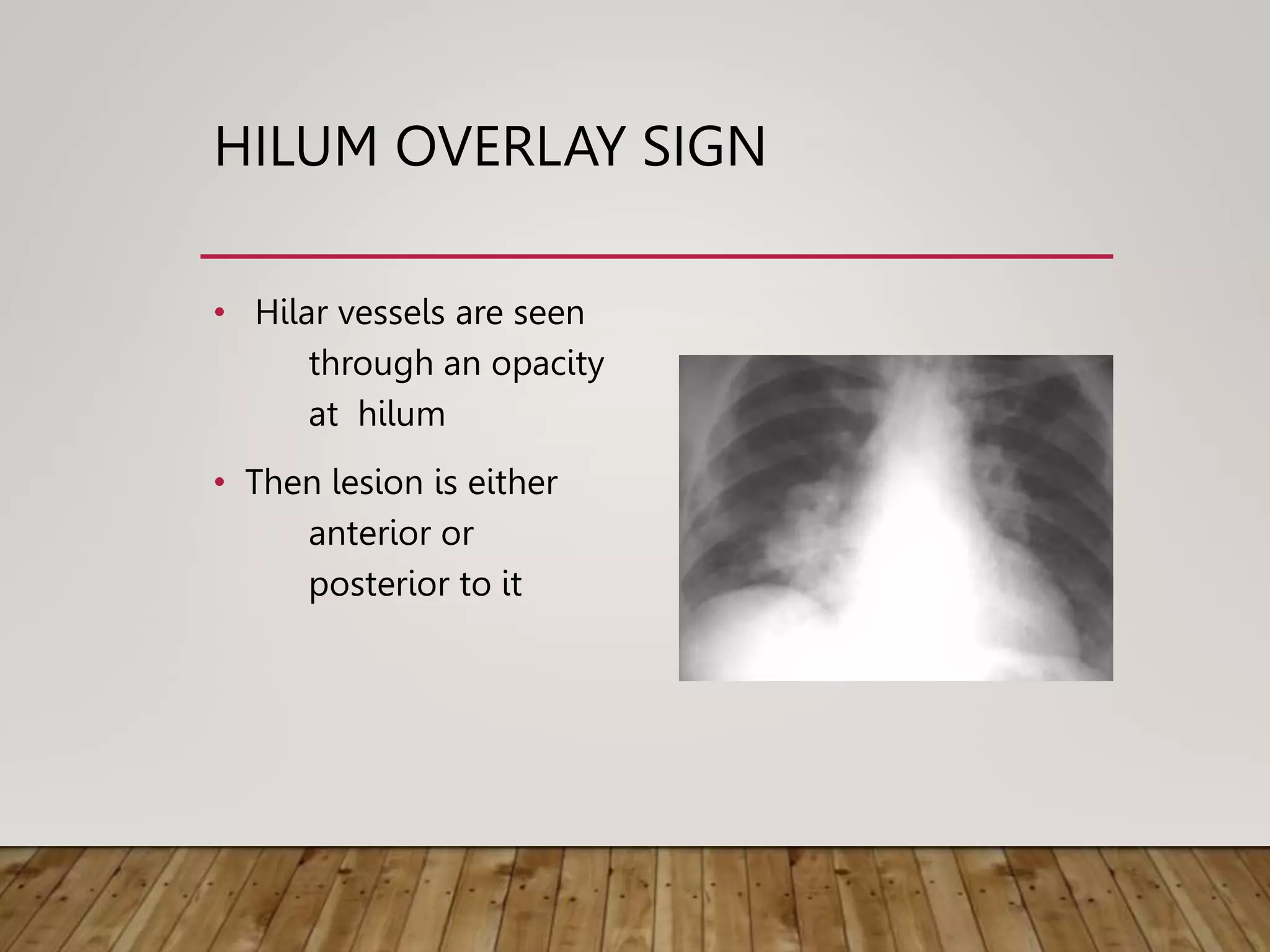 chest x ray interpretation.pptx