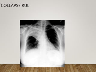chest x ray interpretation.pptx