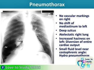 Chest Xray Interpretation of various common diseases.pdf
