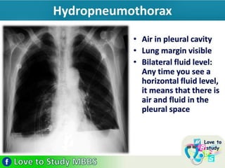 Chest Xray Interpretation of various common diseases.pdf