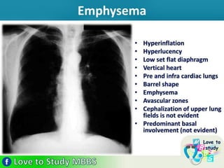 Chest Xray Interpretation of various common diseases.pdf