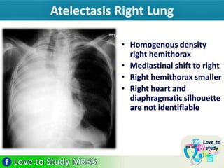 Chest Xray Interpretation of various common diseases.pdf