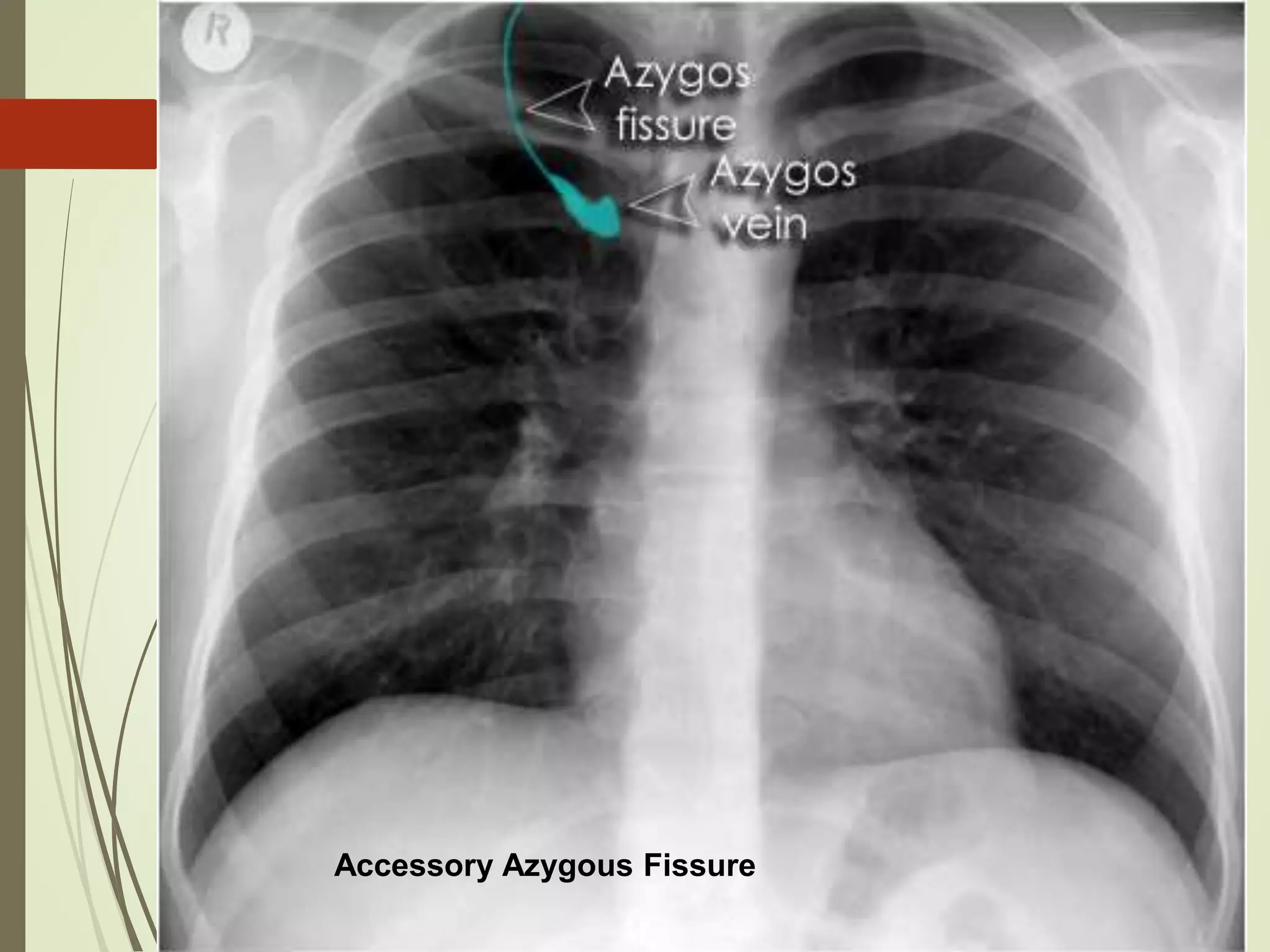 Chest Xray - How to read & interpret | PPTX