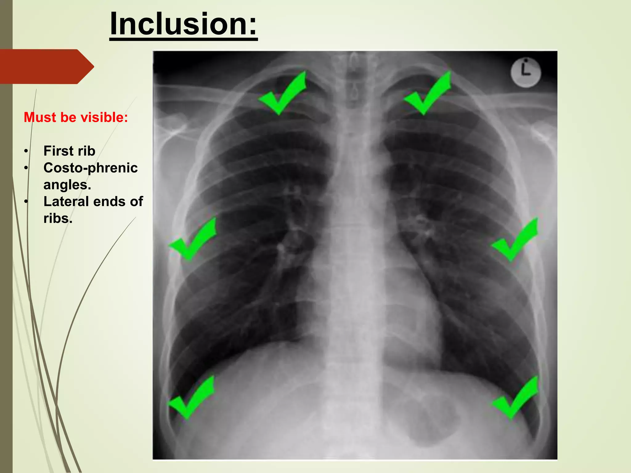 Chest Xray - How to read & interpret | PPTX