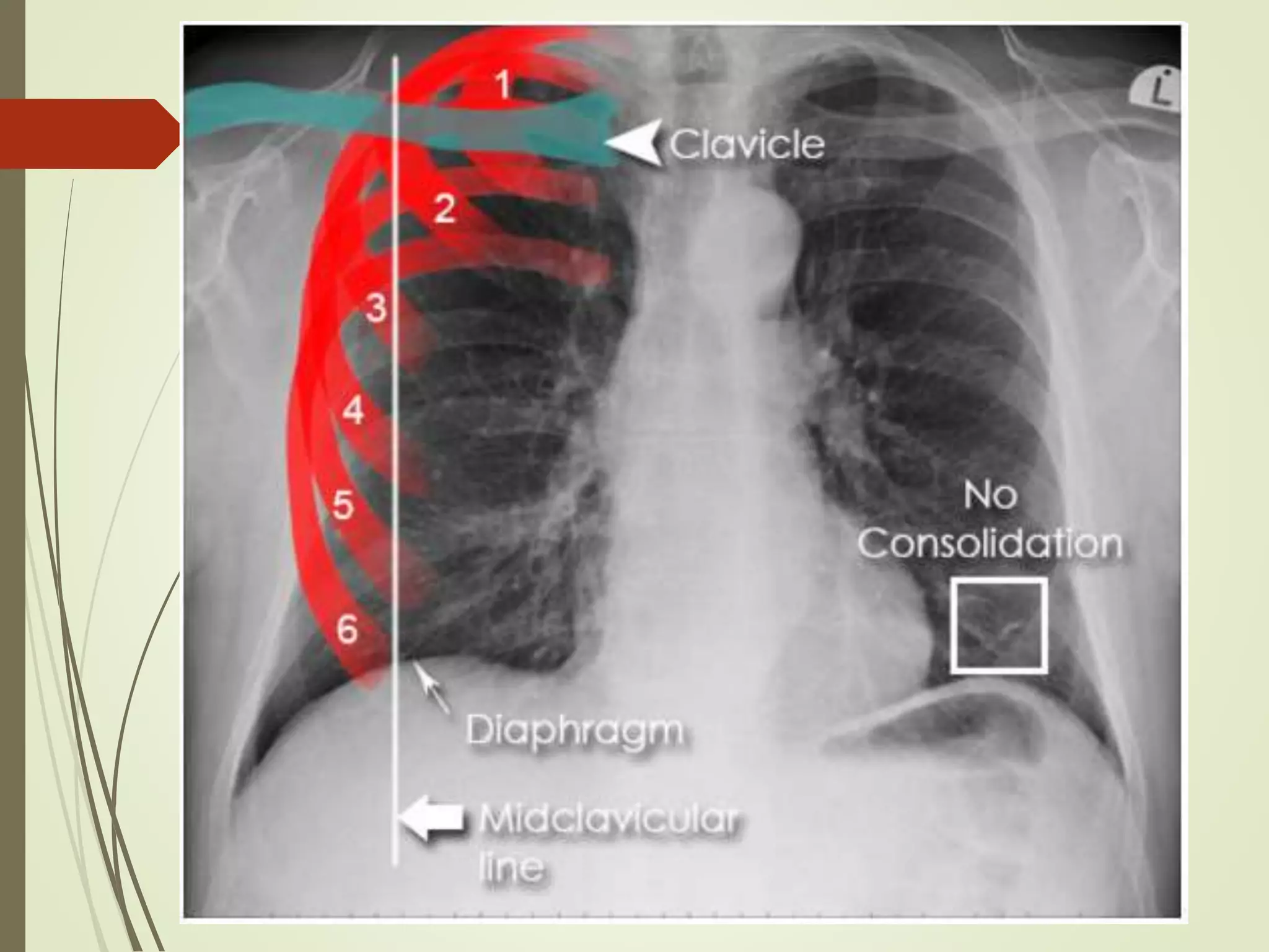 Chest Xray - How to read & interpret | PPTX