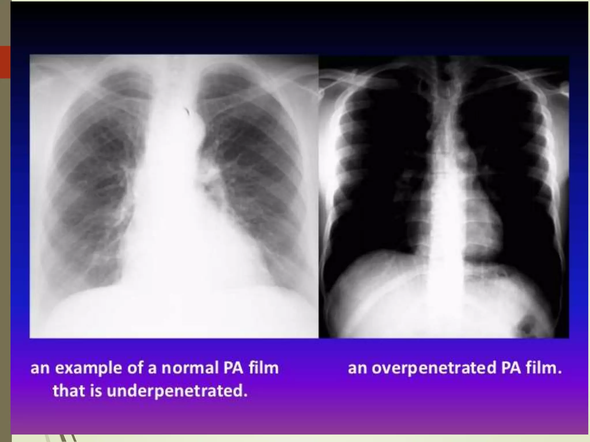 Chest Xray - How to read & interpret | PPTX