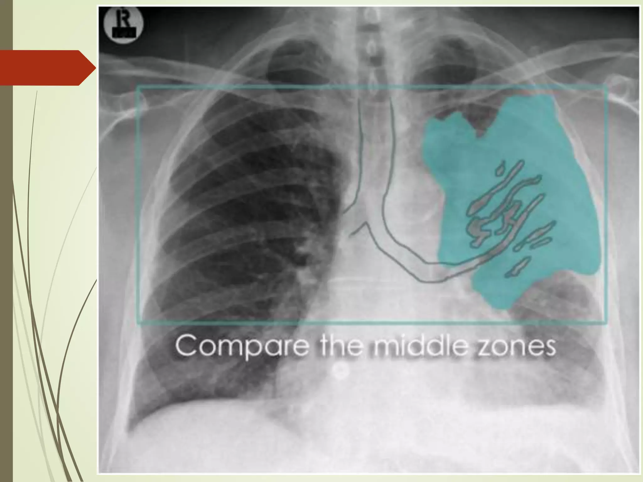 Chest Xray - How to read & interpret | PPTX