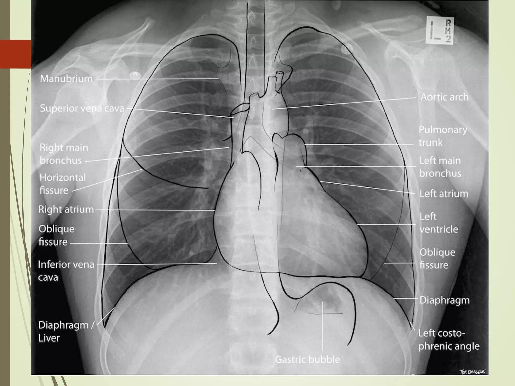 Chest Xray - How to read & interpret | PPTX