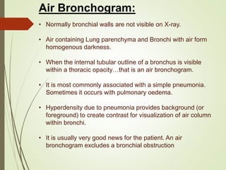 Chest Xray - How to read & interpret | PPTX