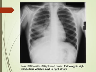 Chest Xray - How to read & interpret | PPTX