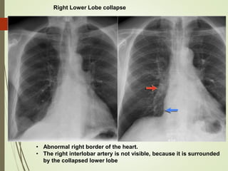 Chest Xray - How to read & interpret | PPTX
