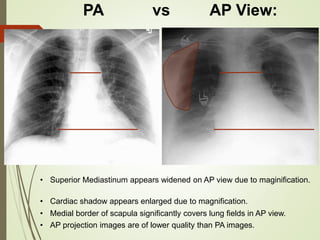 Chest Xray - How to read & interpret | PPT