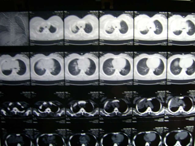 CXR: Silhoutte Sign | PPTX