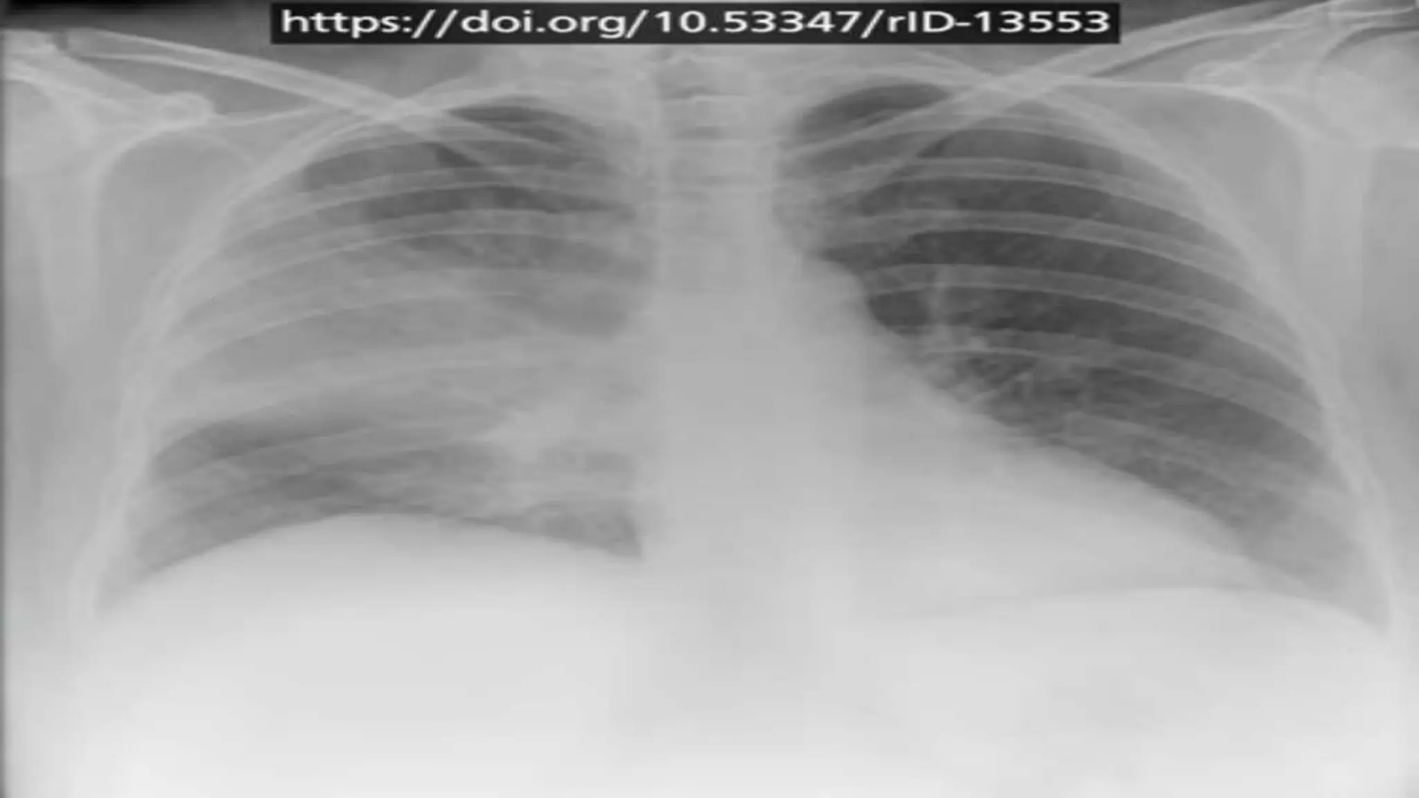 Chest xray pathologies interpretation.pptx | Lung and Respiratory ...