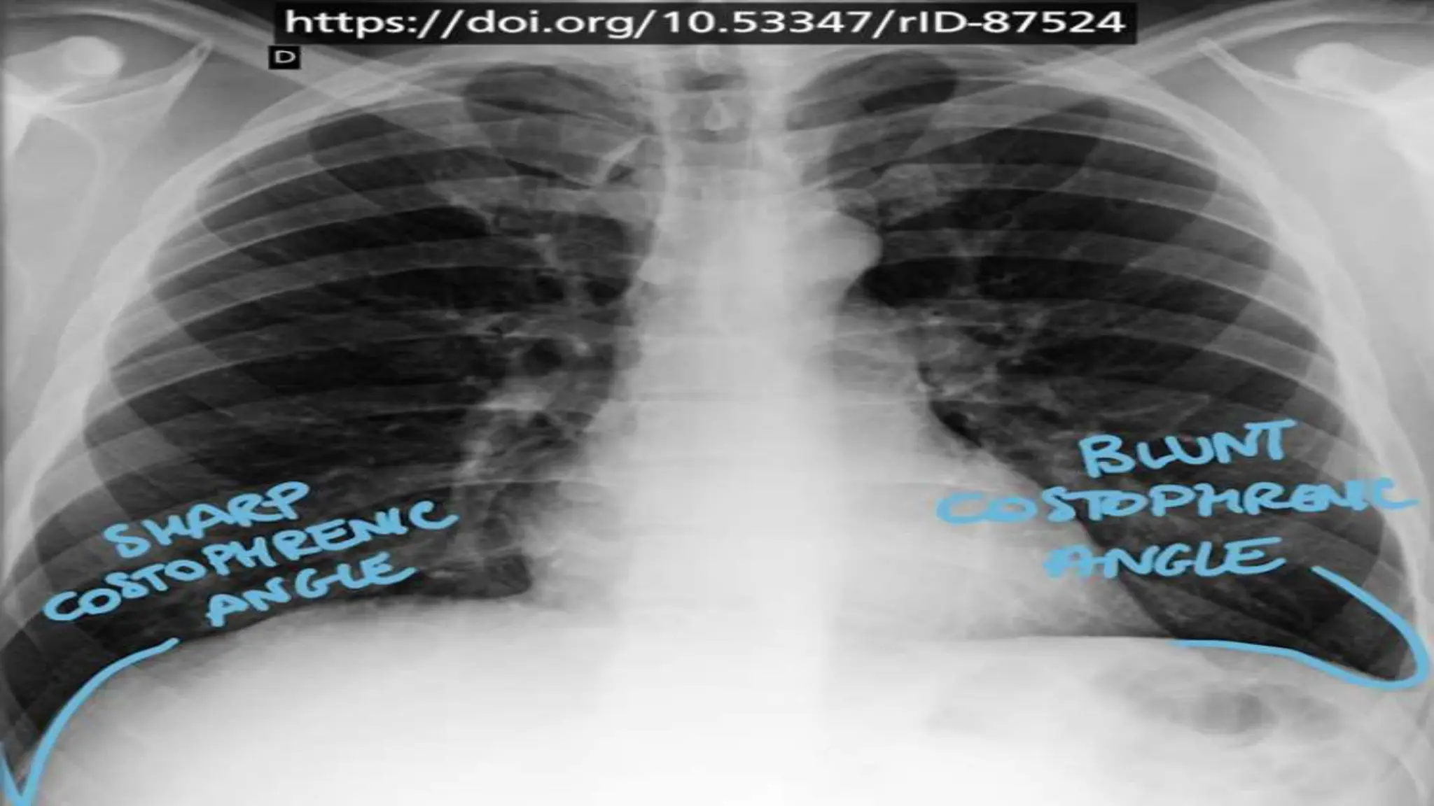 Chest xray pathologies interpretation.pptx | Lung and Respiratory ...