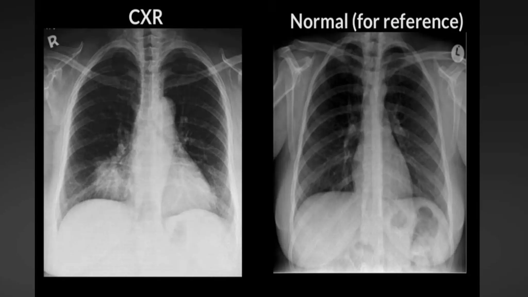 Chest xray pathologies interpretation.pptx | Lung and Respiratory Health | Diseases and Conditions