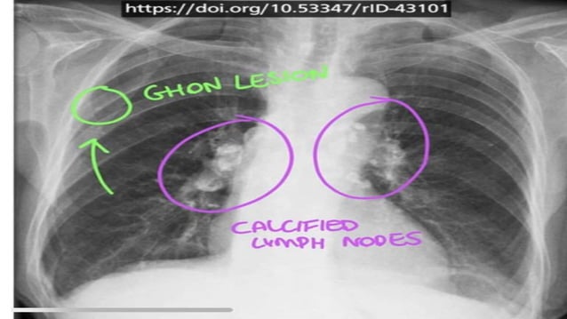 Chest xray pathologies interpretation.pptx | Lung and Respiratory ...