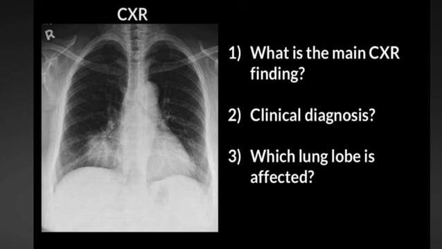 Chest xray pathologies interpretation.pptx | Lung and Respiratory ...