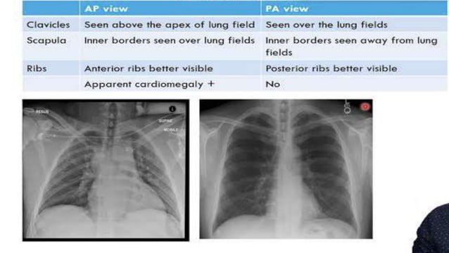 Chest xray pathologies interpretation.pptx | Lung and Respiratory Health | Diseases and Conditions