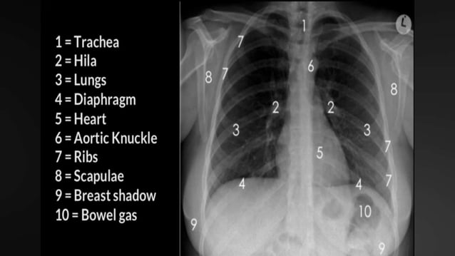 Chest xray pathologies interpretation.pptx | Lung and Respiratory ...