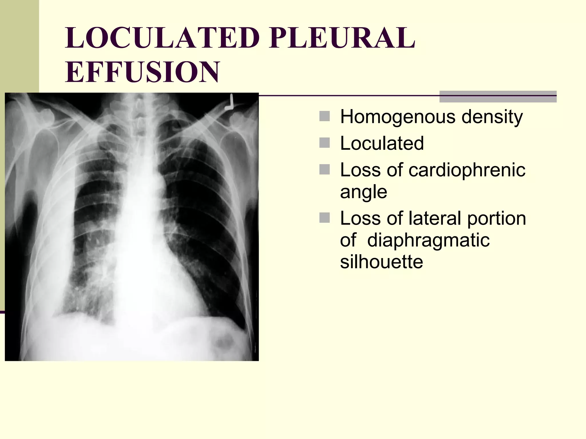 Chest x ray pathology | PPT