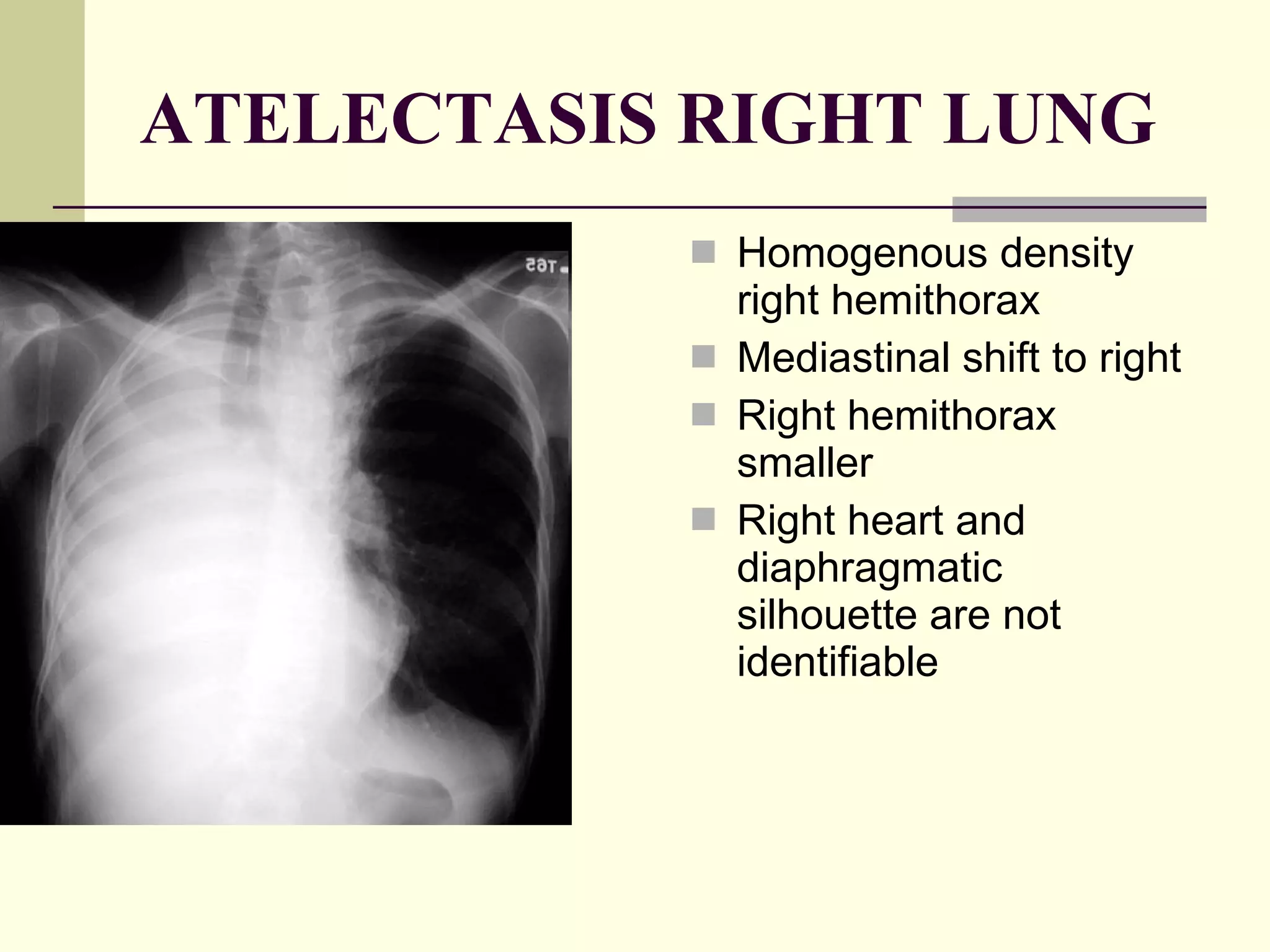 Chest x ray pathology | PPT