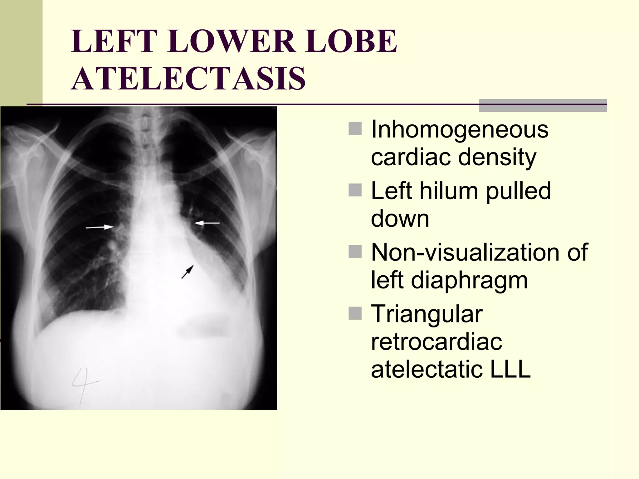 Chest x ray pathology | PPT